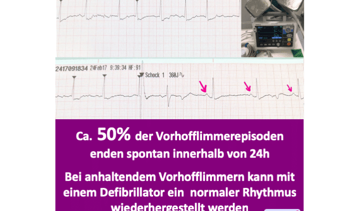 So funktioniert eine elektrische Therapie bei Vorhofflimmern - Cardiopraxis