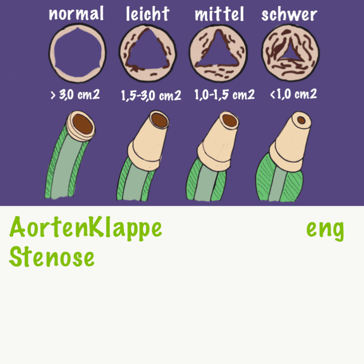 Häufiger Herzklappenfehler: die Aortenklappenstenose | | Cardiopraxis®
