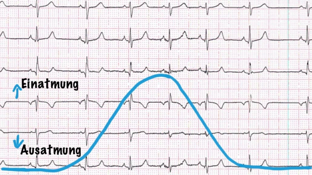Normaler Puls - Sinusrhythmus - Smartphone EKG Routinemessung ...