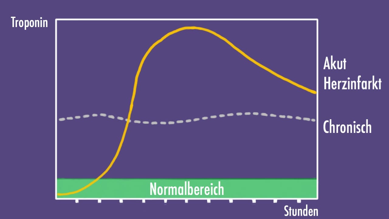 Troponin-Test positiv - Herzinfarkt und andere Ursachen | | Cardiopraxis®