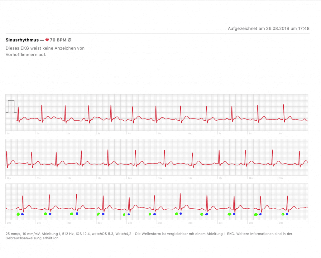 Normaler Puls - Sinusrhythmus - Smartphone EKG Routinemessung ...