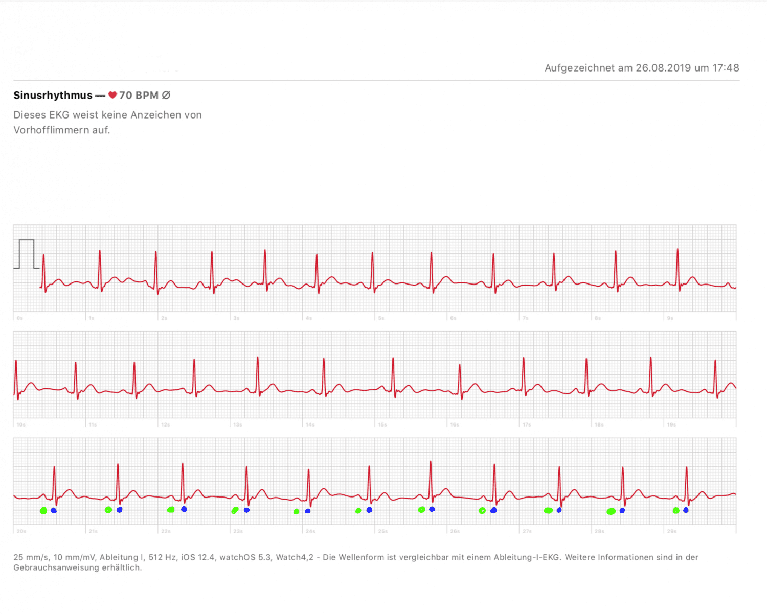 Normaler Puls - Sinusrhythmus - Smartphone EKG Routinemessung ...
