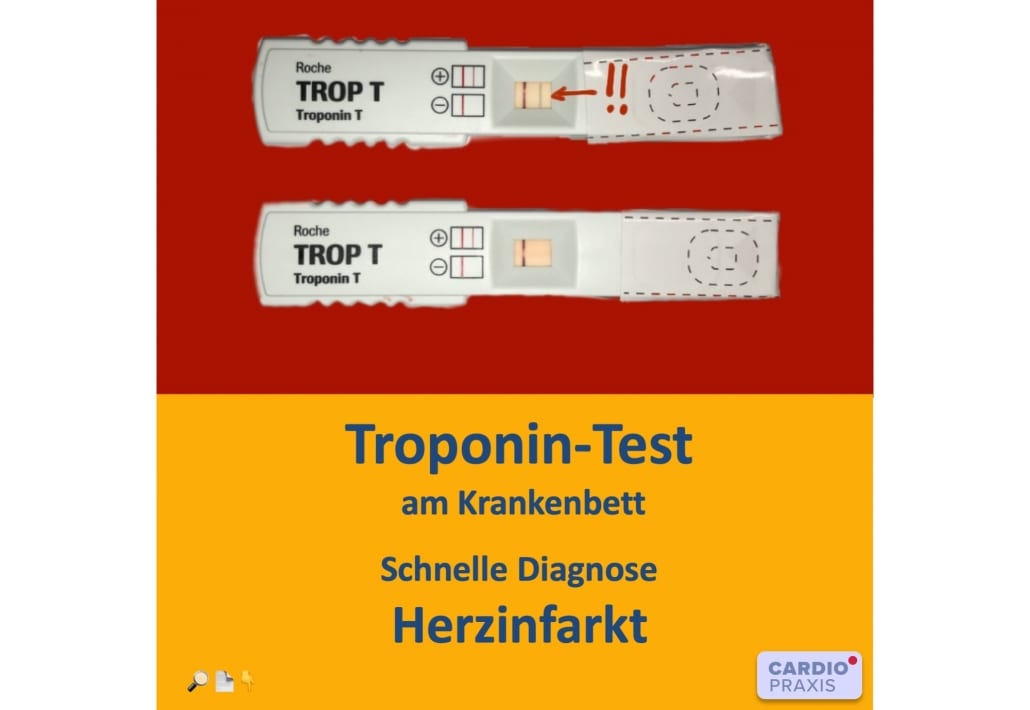 Troponin-Test positiv - Herzinfarkt und andere Ursachen - Cardiopraxis