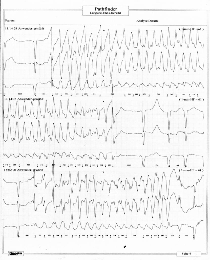 QT-Zeit im EKG - Nebenwirkungen von Medikamenten | | Cardiopraxis®