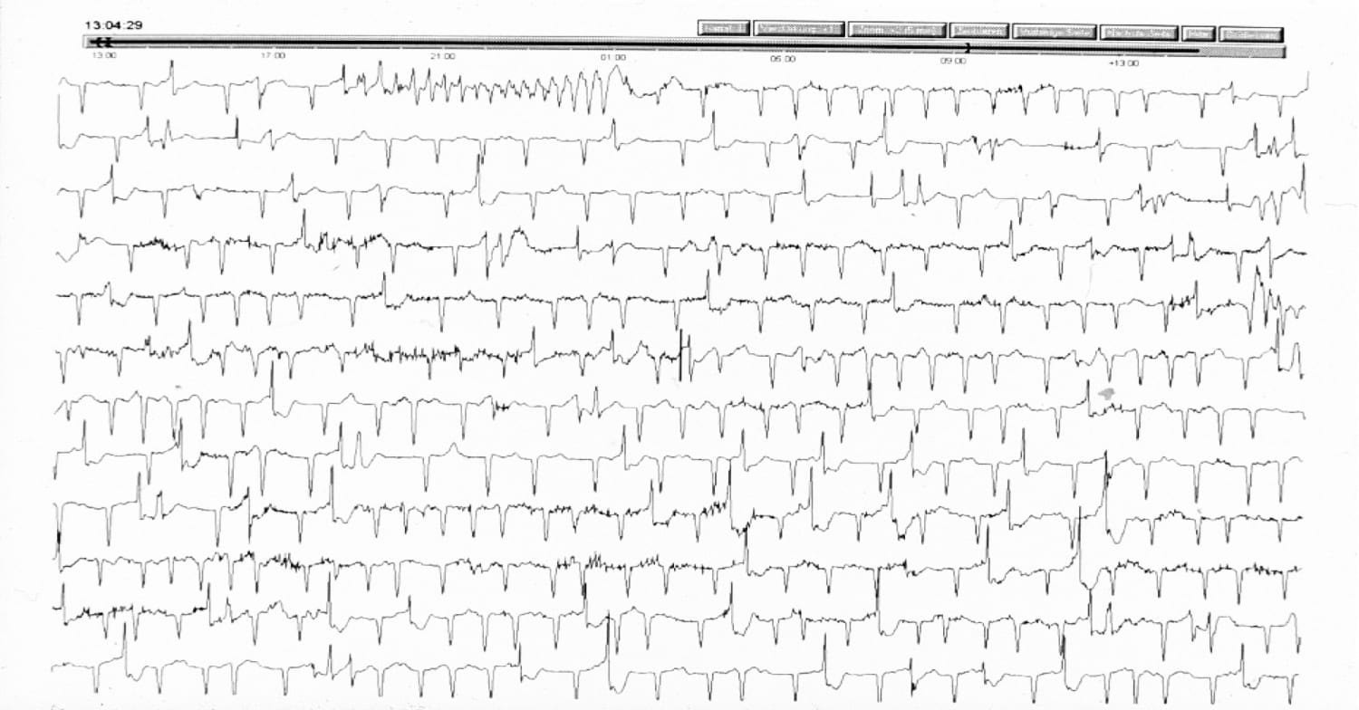 QT-Zeit im EKG - Nebenwirkungen von Medikamenten | | Cardiopraxis®