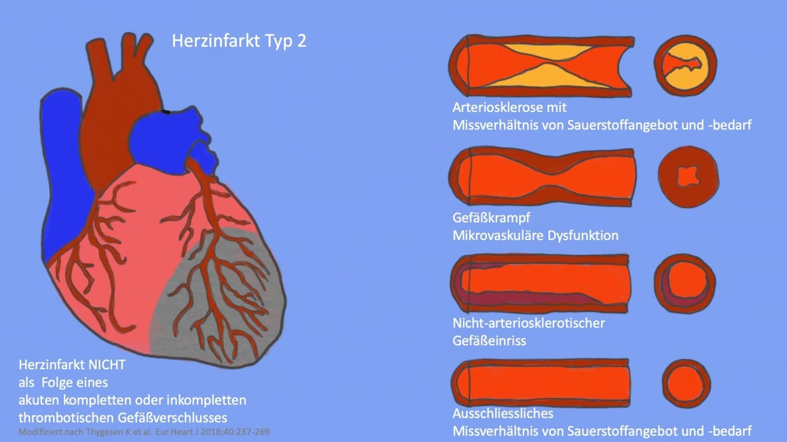 Ein Herzinfarkt kann verschiedene Ursachen haben | | Cardiopraxis®