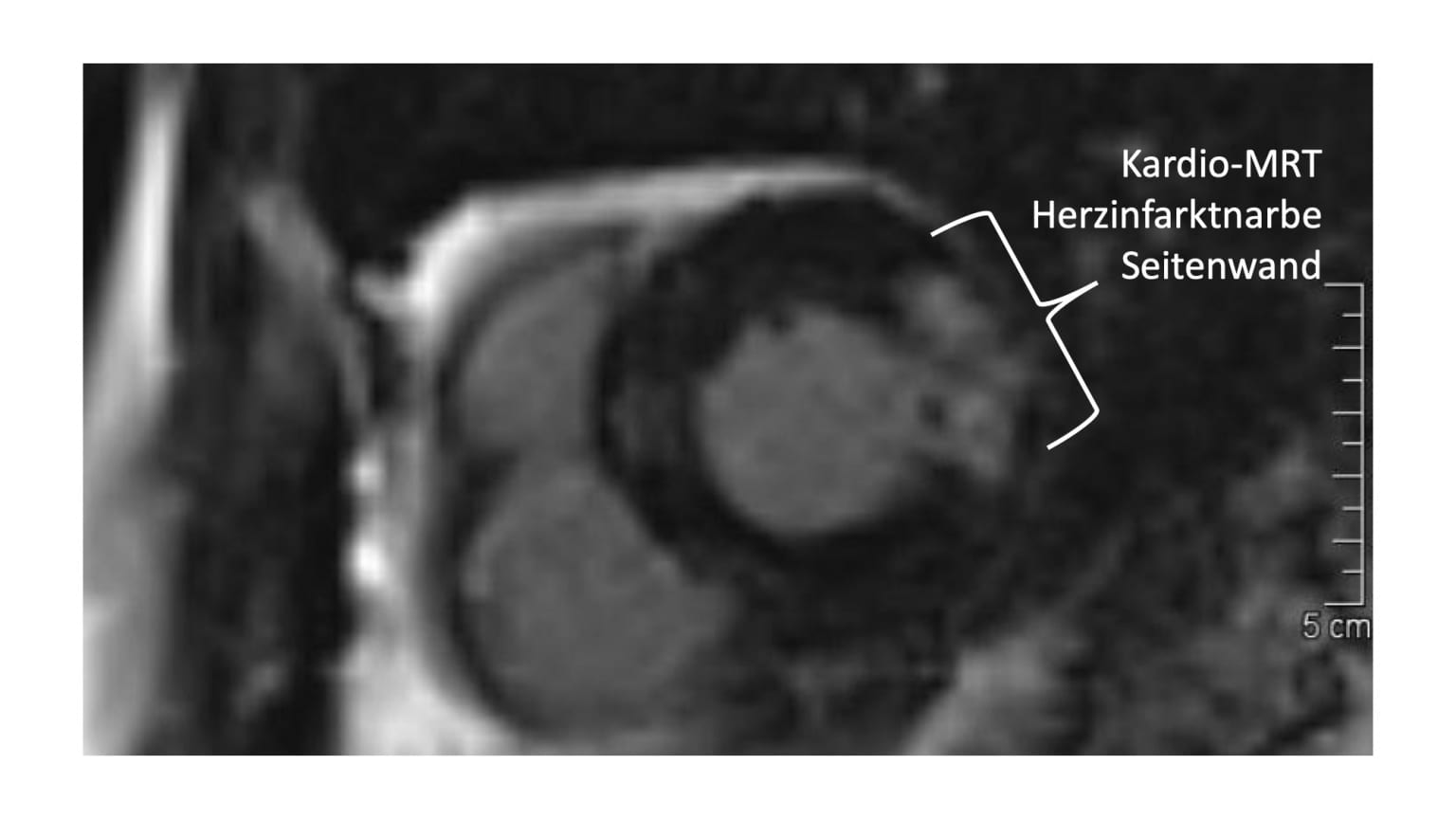 Stummer Herzinfarkt: Hohes Risiko ohne Symptome